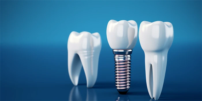 A Comprehensive Guide to Malo All-on-4 Dental Implants What - Ruli